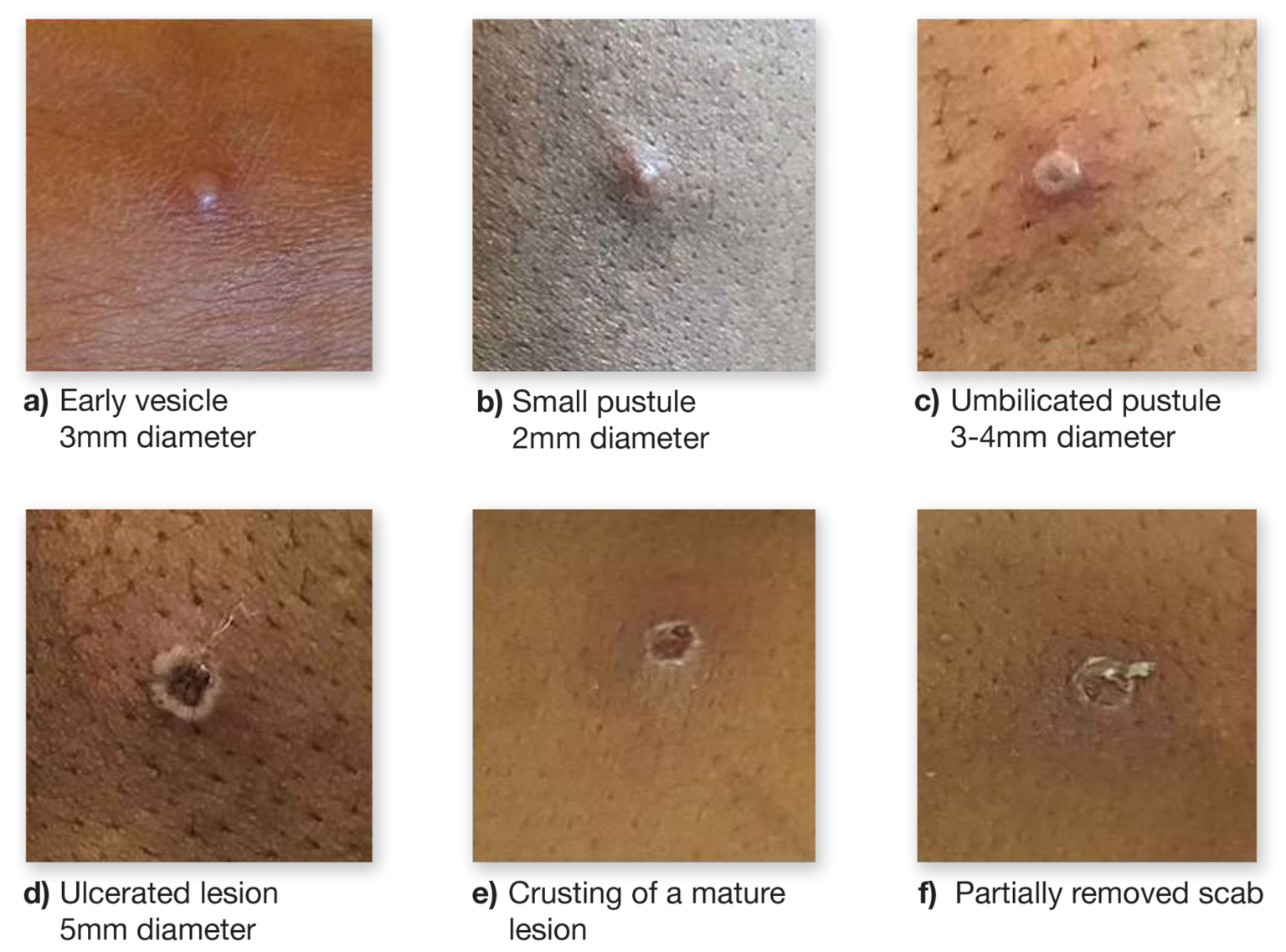 How High Is The Risk Of Catching Mpox And How Can I Protect Myself Uk Health Security Agency